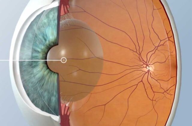 Cataract Surgery And Glaucoma - Glaucoma Research Foundation