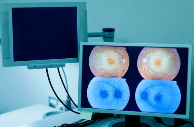 Optic Nerve Cupping Explained: Signs & Eye Health